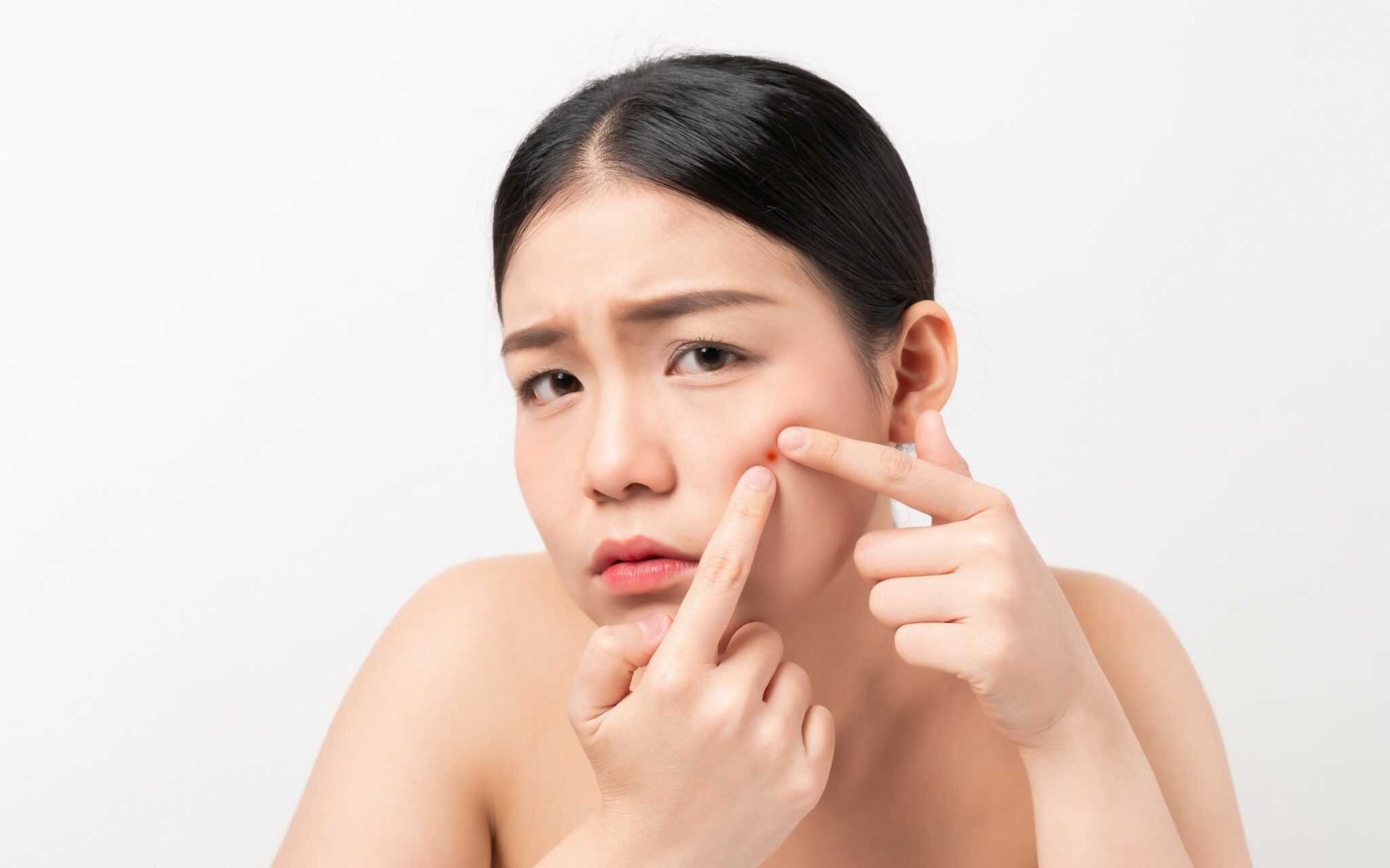 How to Get Rid of a Pimple Overnight