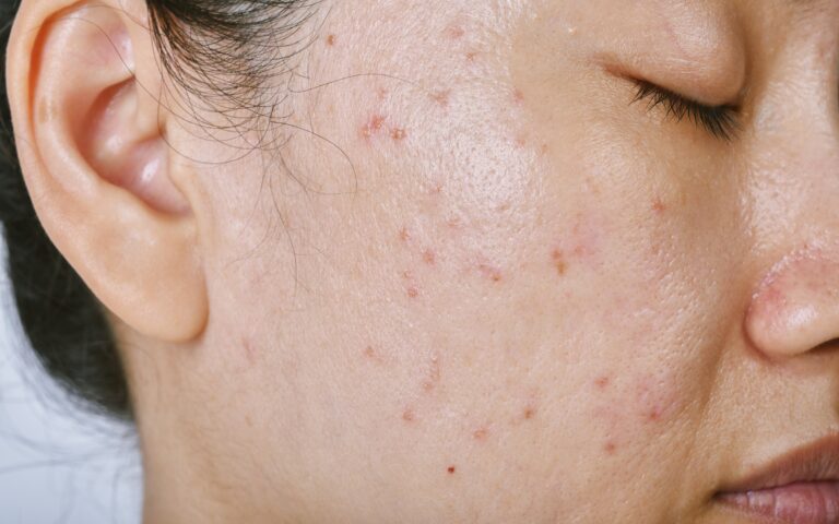 Understanding Acne Papules: Causes, Treatment, and Prevention Strategies: The Derm Spot