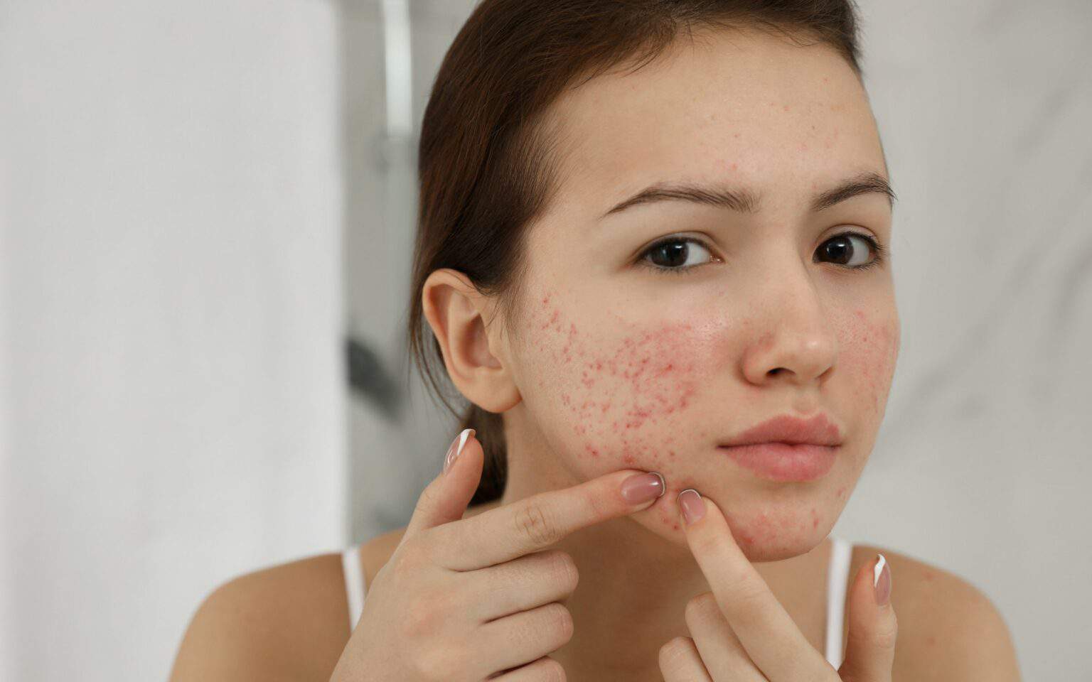 Effective Acne Treatment Solutions for Teens | The Derm Spot