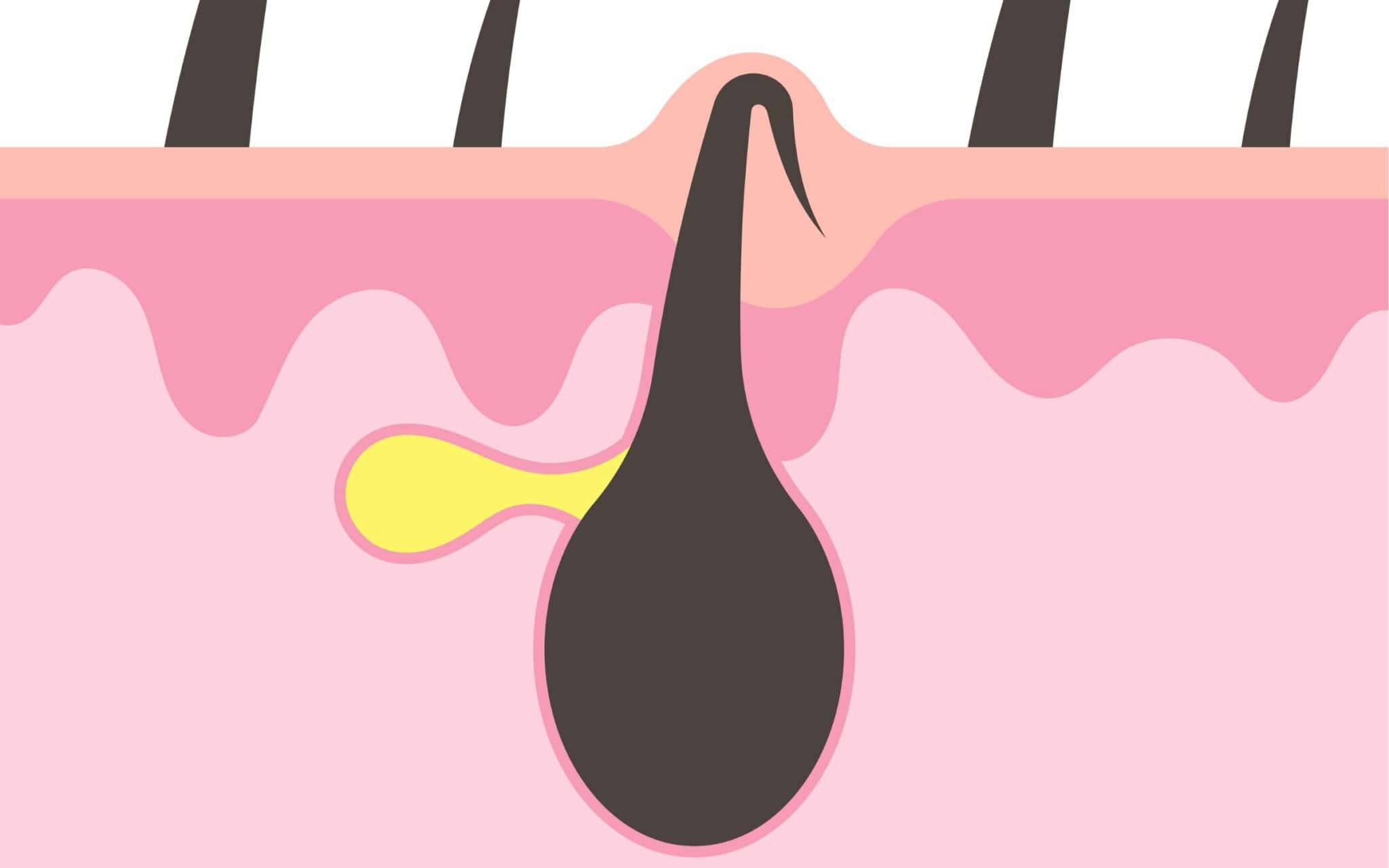 Ingrown Hair: Comprehensive Guide to Smooth Armpits