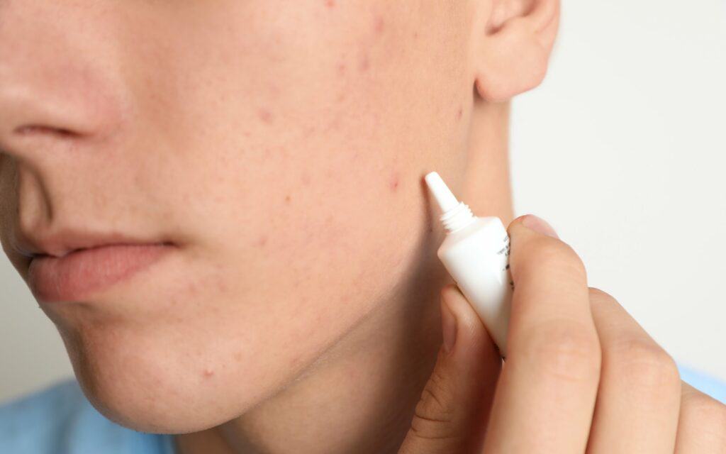 Effective Acne Spot Treatment | The Derm Spot