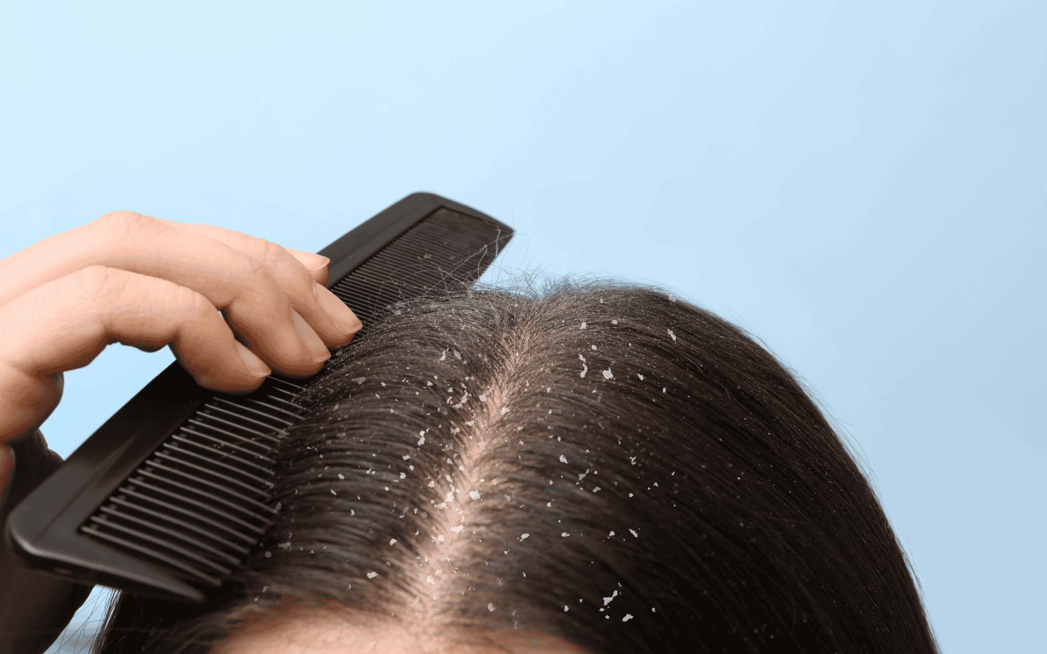 Dandruff vs. Dry Scalp: Key Differences & Treatments | The Derm Spot