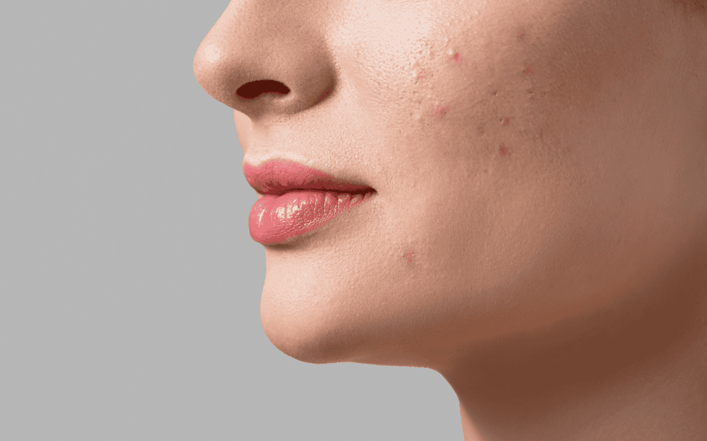 How to Get Rid of Cystic Acne: Expert Tips & Treatments | The Derm Spot