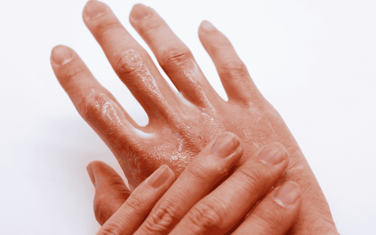 Dry Hands Causes & Treatment Options