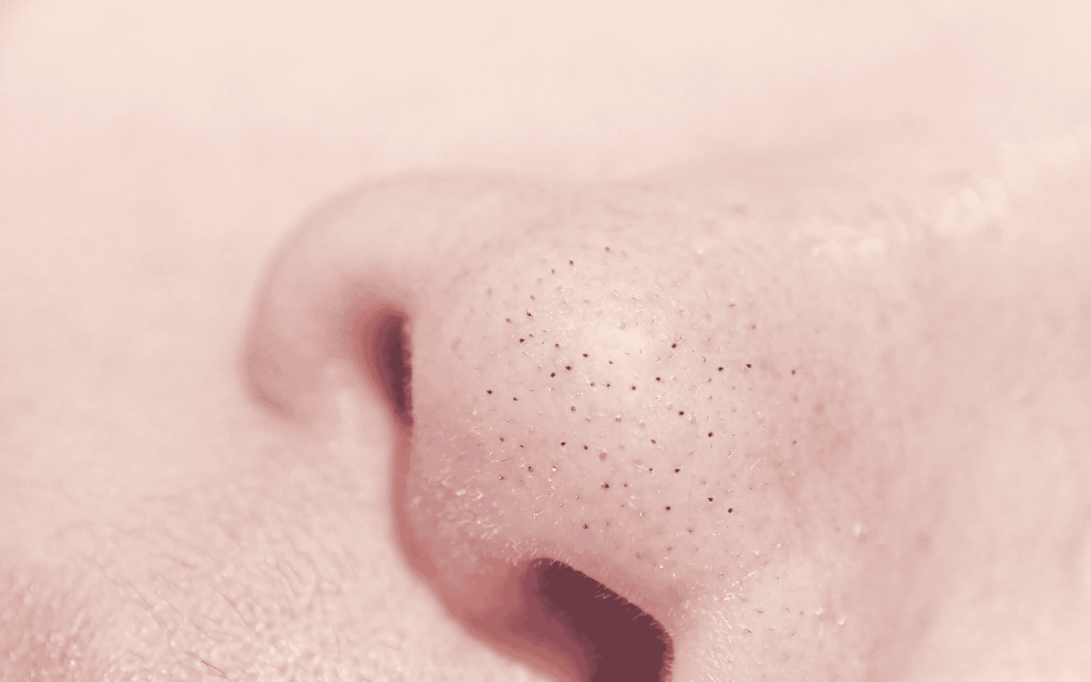 Sebaceous Filaments: Causes, Treatment & Prevention | The Derm Spot