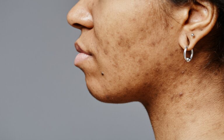 Melasma vs. Hyperpigmentation | Understand the Difference and Treatments