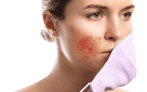 What is Cortisol Face? Effects on Skin and Hair Health Explained