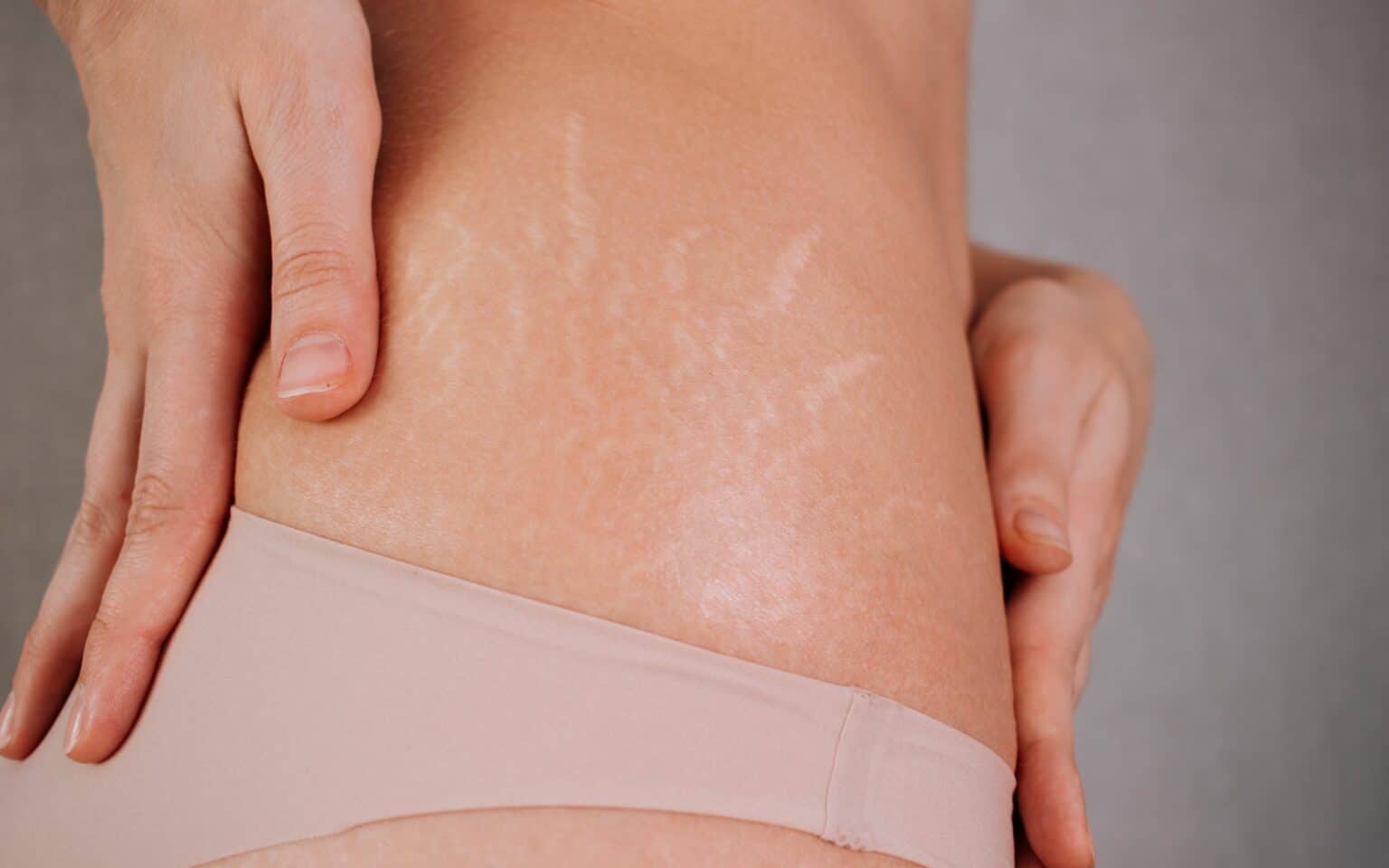 10 Essential Tips for Choosing the Best Stretch Mark Oils for Smooth ...