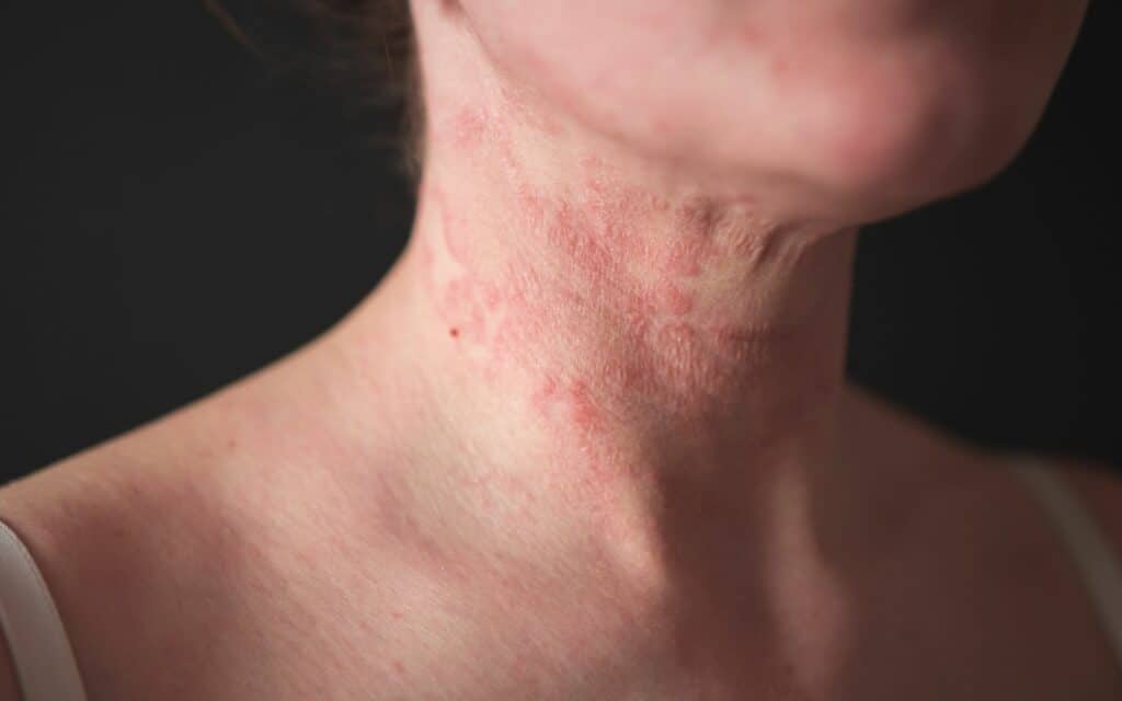 Rash from Sweat: Causes, Prevention & Care Guide