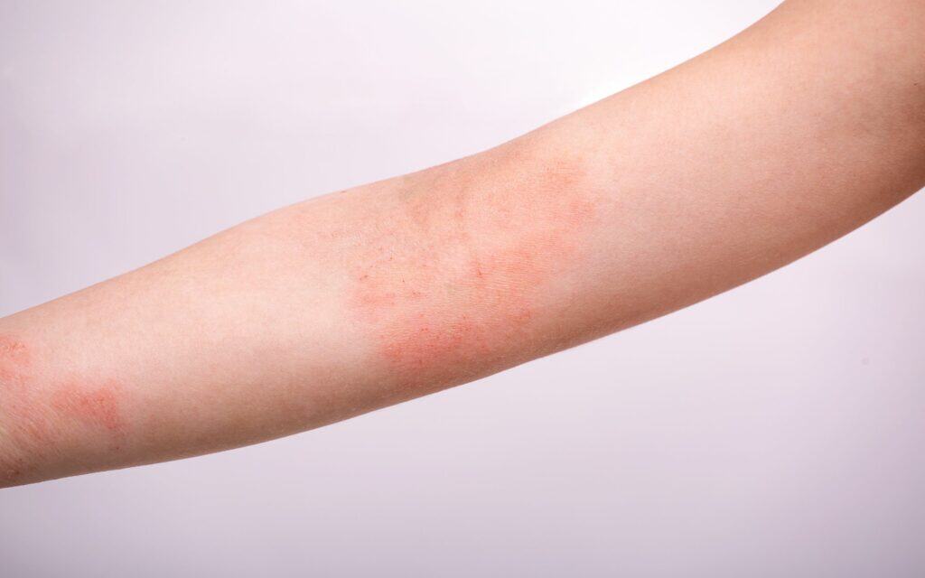How to Manage Contact Dermatitis Rash: Complete Guide