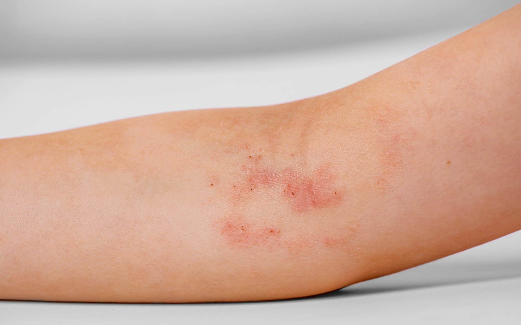 Allergic Contact Dermatitis: Symptoms, Causes & Care