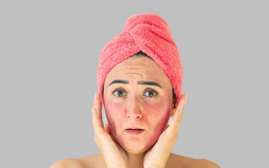 Sweat Rash: Causes, Prevention & Treatment Guide