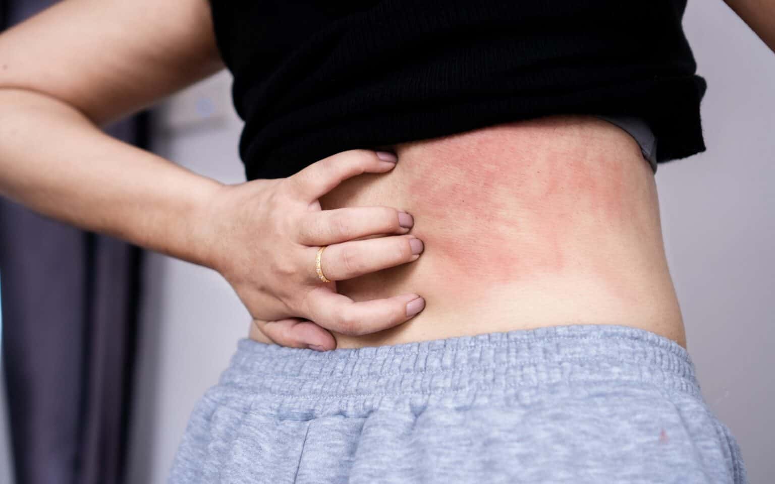 Fungal Sweat Rash: Causes, Treatment & Prevention Guide