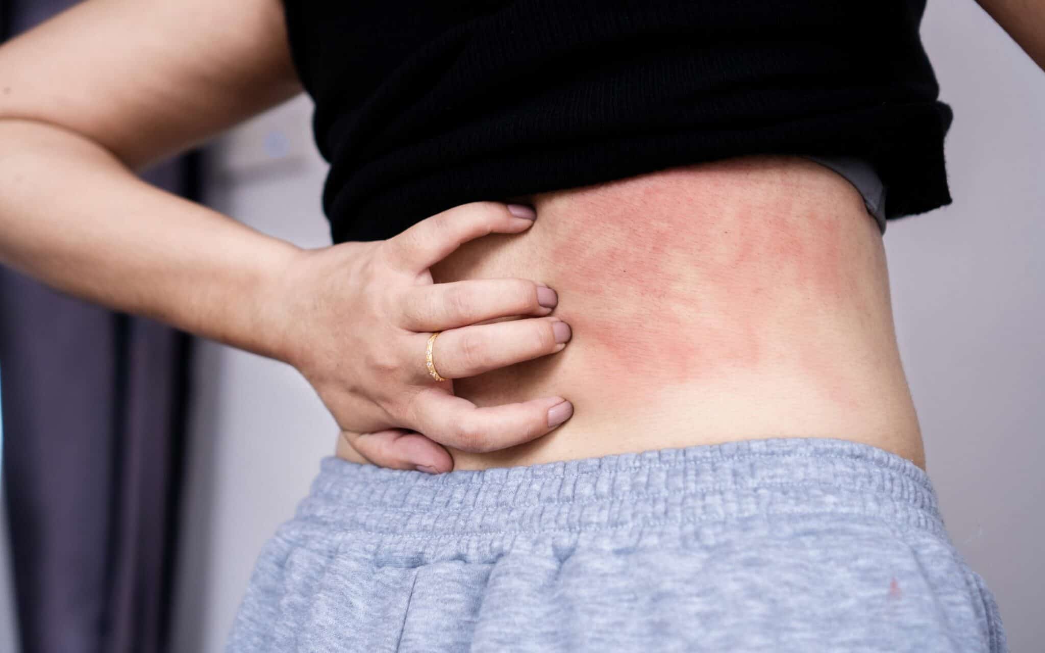 Fungal Sweat Rash: Causes, Treatment & Prevention Guide