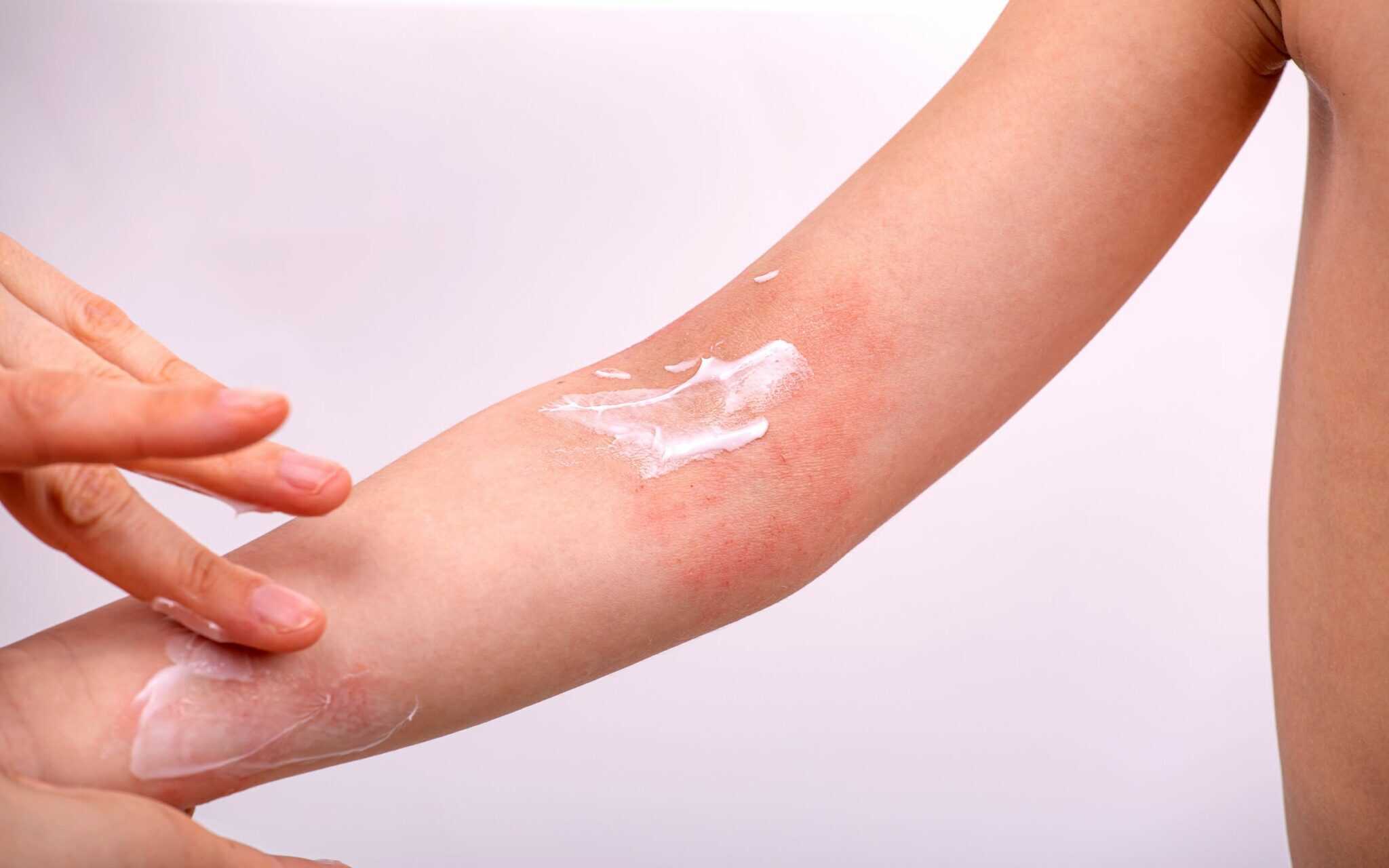 Contact Dermatitis Treatment: Relief Tips & Remedies