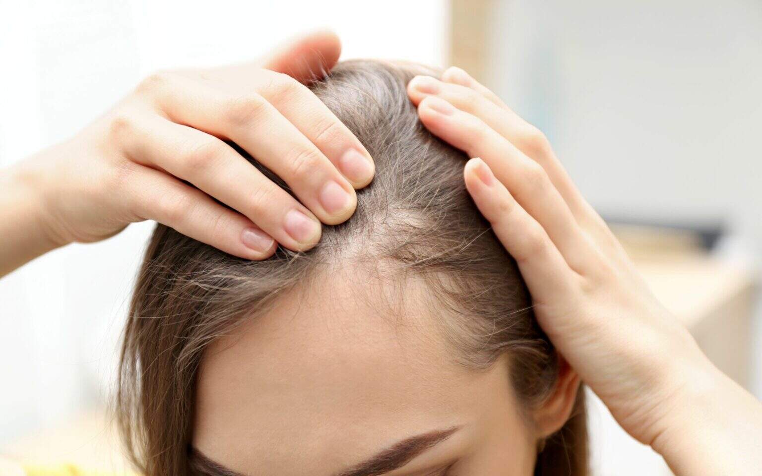 How to Prevent Hair Loss in 2026 Dermatologist-Backed Guide