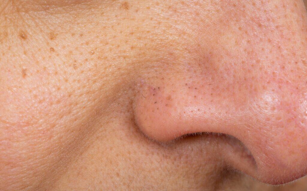 Large Nose Pores 2025: How to Minimize & Treat