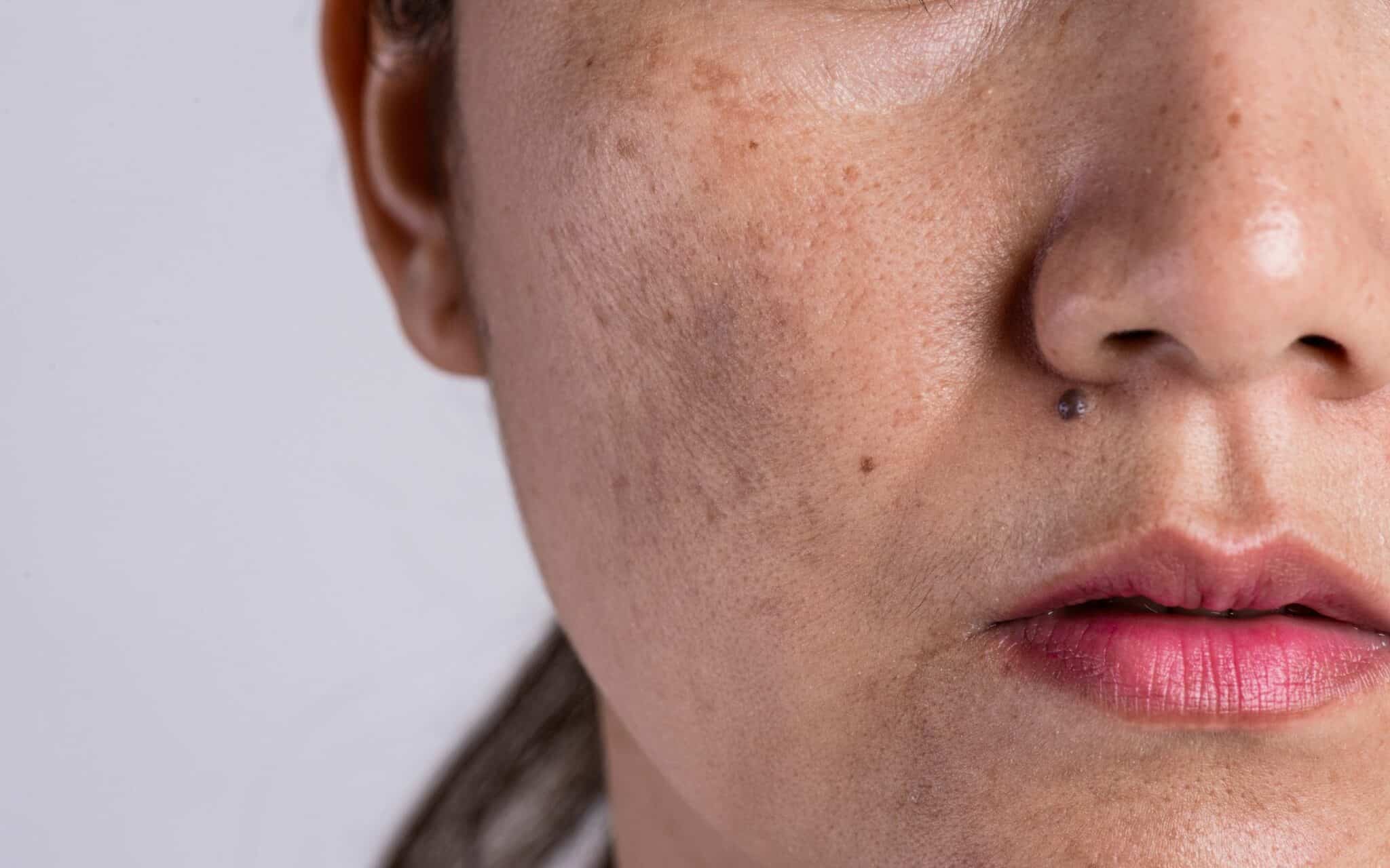 Rash from Sweat: Causes, Prevention & Care Guide