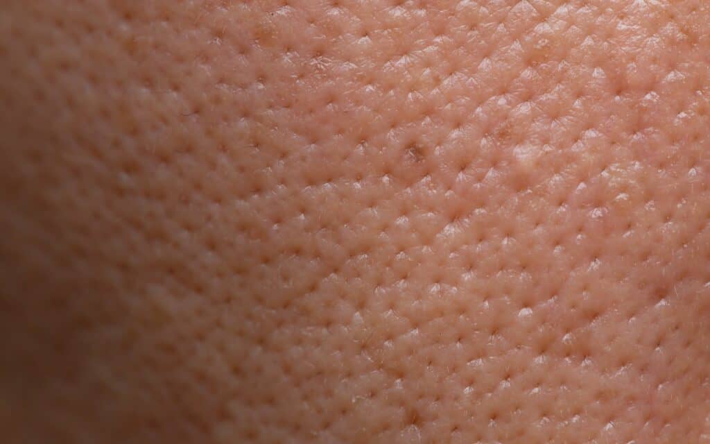 Strawberry Skin on Arms: Causes & Fixes Guide